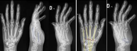 Anterior Posterior Lateral And Oblique Radiography And Palmar Download Scientific Diagram