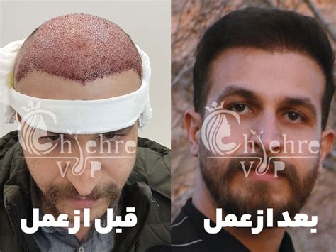 دکتر بهزاد دالوند مجموعه کاشت مو چهره Vip