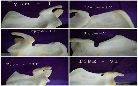 The 6 Types Of Suprascapular Notch According To Rengachary Download Scientific Diagram