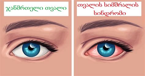 თვალის მუდმივი სიმშრალე გავრცელებული სინდრომია როგორ მოვიქცეთ