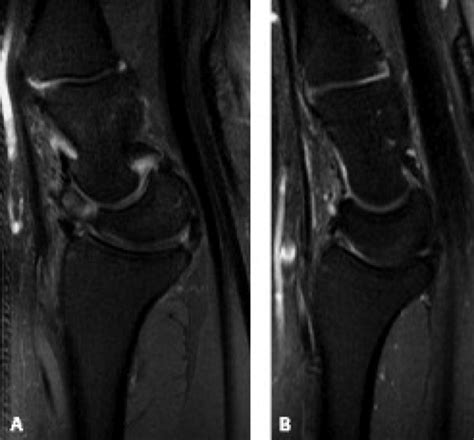 Miscellaneous Conditions Of The Wrist Radiology Key Miscellaneous Conditions Of The Wrist Radiology Key