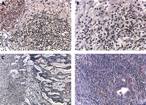 runx3 expression in primary and metastatic pancreatic cancer journal