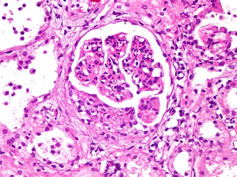 Poststreptococcal Glomerulonephritis Histology At Rose Braddon Blog