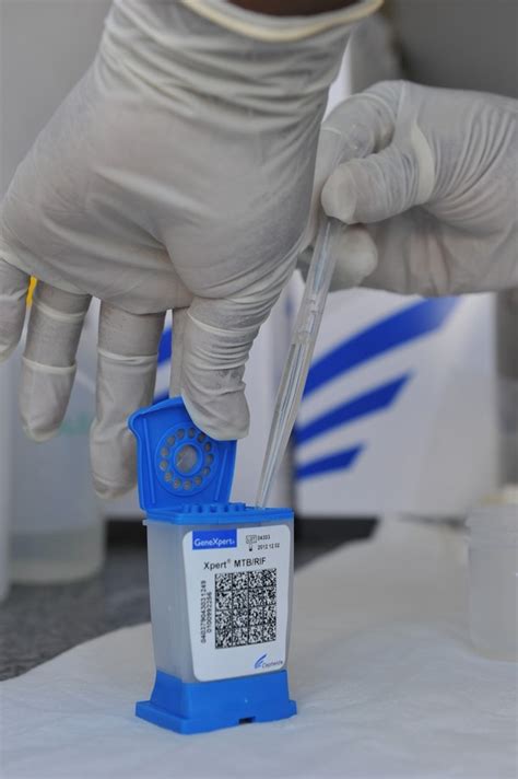 Sputum Test May Not Hold Key To Tb Eradication Study Texila Connect