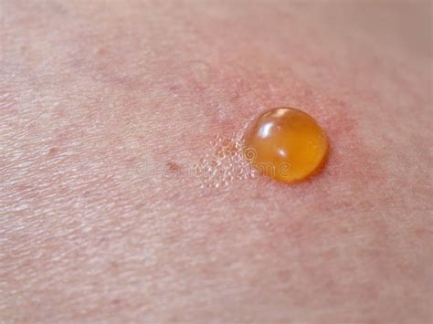 Mosquito Bite Allergy Blisters