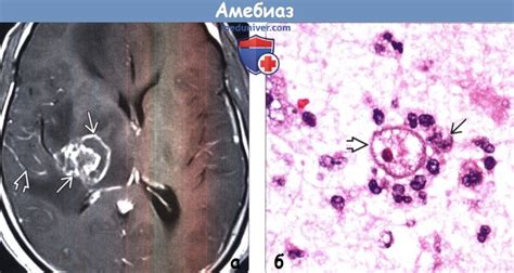 Амебиаз головного мозга на МРТ