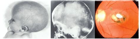 Congenital Toxoplasmosis Calcifications