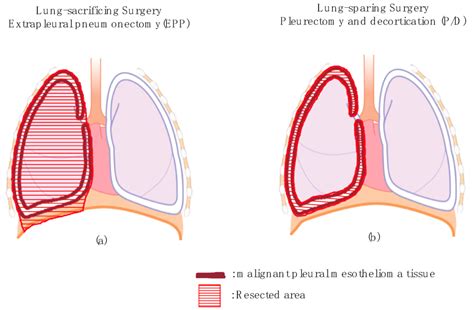 Pleural Mesothelioma Surgery