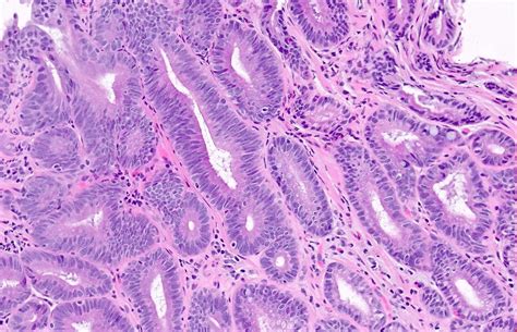Gastric Intestinal Metaplasia With Dysplasia Ljerge