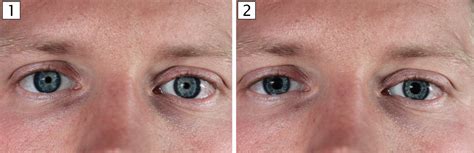 Causes Of Pinpoint Pupils Medizzy