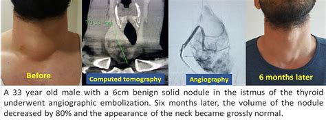 Case Examples Thyroid Goiter