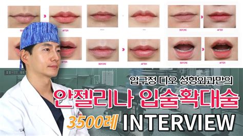 [eng 성형지식] 입술 확대 수술 3 500회 돌파 👄 입술 장인 성형외과전문의를 인터뷰 해봤습니다😎 Youtube