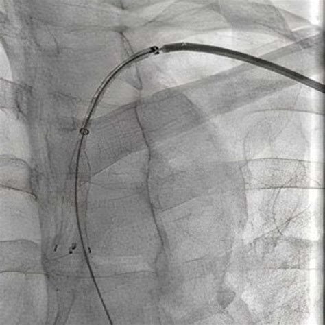 Deployment Of The Self Expanding Covered Stent Download Scientific