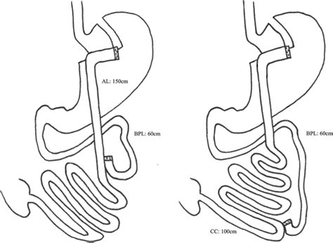 Illustration Of Limb Lengths In Proximal Roux En Y Gastric Bypass