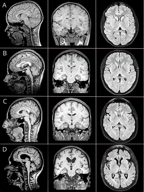 Mri Brain Normal