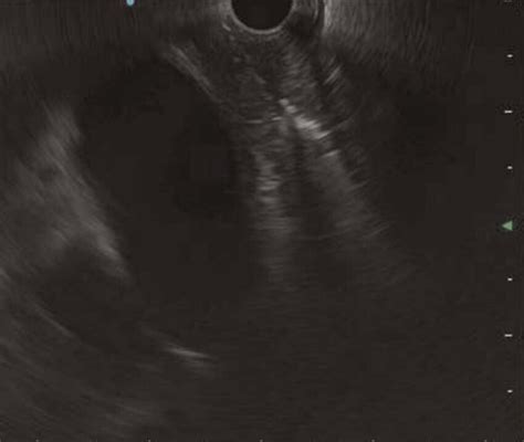 On Eus Image Esophageal Wall Was Homogeneously Thickened Download Scientific Diagram