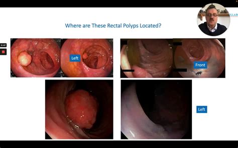 Endocollab™ Gastroenterology And Endoscopy Education On Linkedin Where Are Those Rectal Polyps