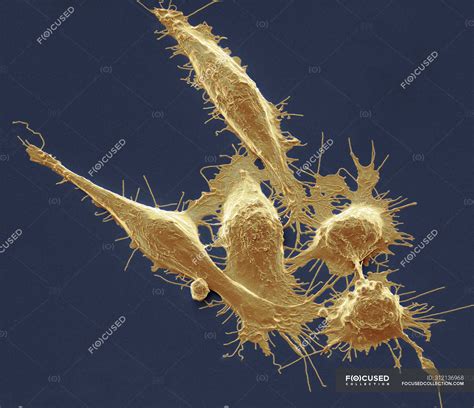 Coloured Scanning Electron Micrograph Of Cancer Cells From Colon