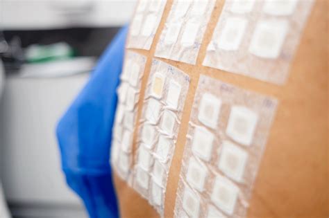 Patch Testing Cathedral Dermatology