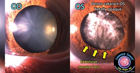 Consider Manual Shelved Incision Cataract Surgery For Dense Brunescent Cataract