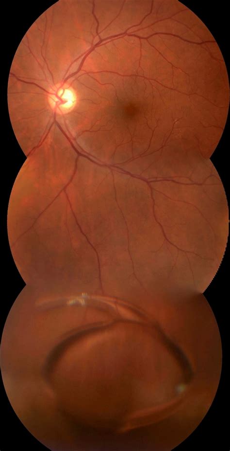 Dislocated Intraocular Lens Iol Retina Image Bank