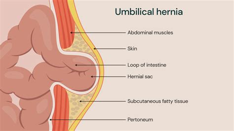 Hernia