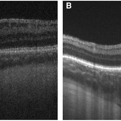 Handheld Swept Source Optical Coherence Tomography Images Obtained From