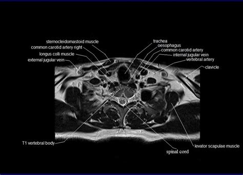 Mri Neck Anatomy Free Mri Axial Neck Cross Sectional Anatomy Brain