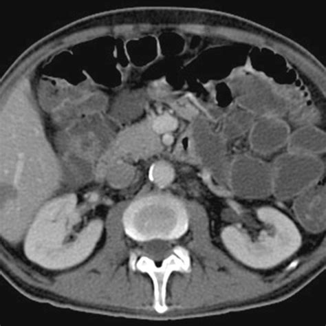 Upper Digestive Endoscopy Of Duodenum A Atrophic Mucosa And Download Scientific Diagram
