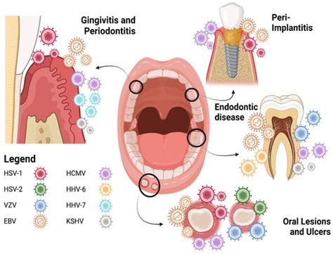 Oral Herpes Throat Nhs