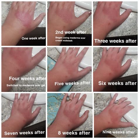 Do Second Degree Burns Scar Golfloco