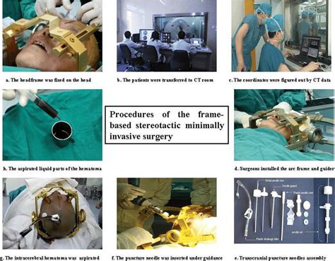 Procedures For The Stereotactic Minimally Invasive Surgery A Download Scientific Diagram