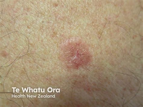 Nodular Bcc Understanding The Importance Of Daily Imaging In The