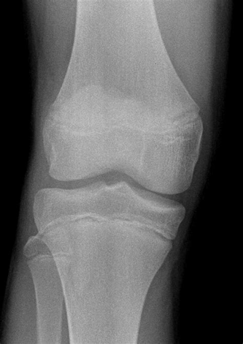 Epiphyseal Fracture X Ray Epiphyseal Fracture X Ray