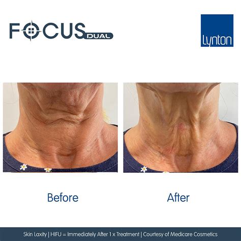Hifu Treatment Comprehensive Guide