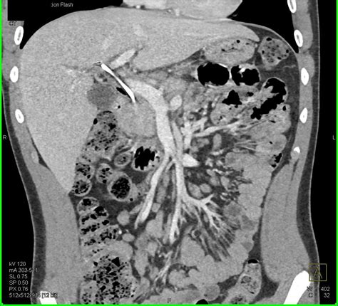 Subtle Pancreatic Cancer With Common Bile Duct Cbd Stent Pancreas