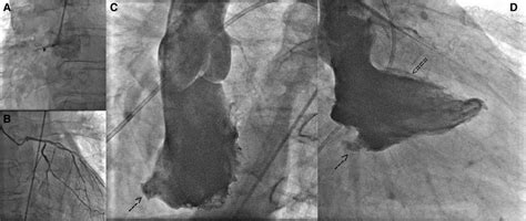 What Is Left Ventricular Free Wall Rupture Xyxwd