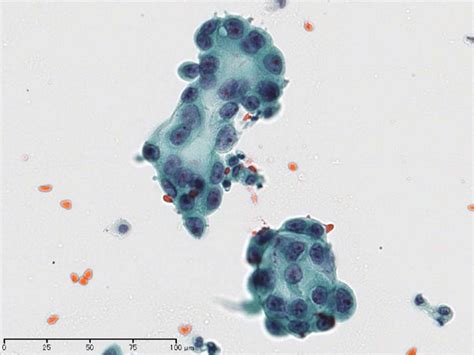 Cytological Examination Of Pleural Effusion The Pleural Effusion Was