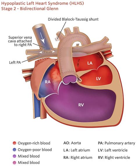Fontan Procedure Uses Types Recovery And Complications