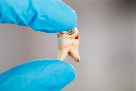Tooth Decay What Are The Causes And How To Prevent It