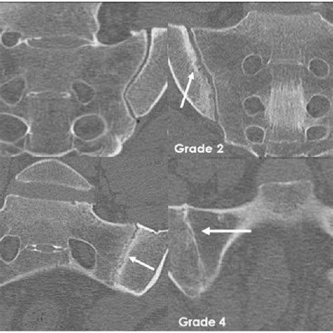 Elementary Structural Lesions On The Si Joint Ct Grade 0 Normal Si