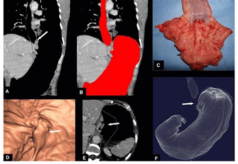 Siewert Type Ii Adenocarcinoma A Coronal Mpr With Soft Tissue Window