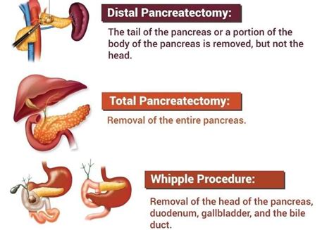 Learn Pancreatic Cancer Treatment And Surgery By Top Pancreatic Surgeon In Delhi India