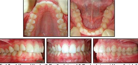 Class Ii Malocclusion Correction With Invisalign Is It Possible Clair Alston