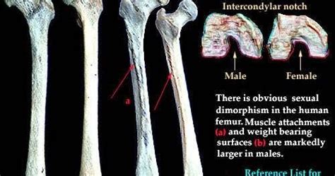 Determining Sex By Using The Femur Forensicpedia
