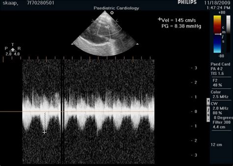 Transvalvular Gradient Of A 180 Day Homograft Smit 2011 Download