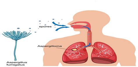 Aspergillosis Disease Causes Symptoms Diagnosis And Treatment Max Lab