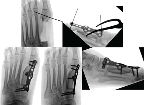 Intraoperative Imaging Demonstrating A Wide Resection Disarticulating