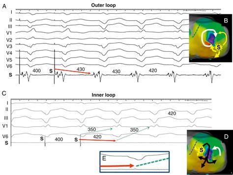 Mapping Scar Related Arrhythmias Clinical Tree