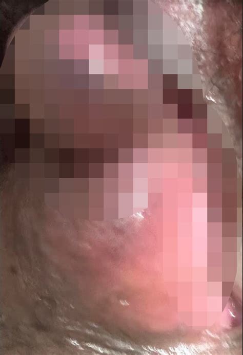 Mum With Cyst So Big It ‘looks Like A Dangling Mini Penis Cant Wear